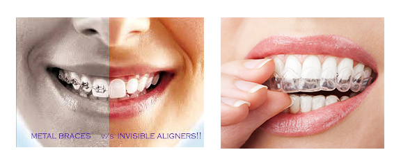 Focus Dental | Invisible Braces for Teens & Adults in Hyderabad