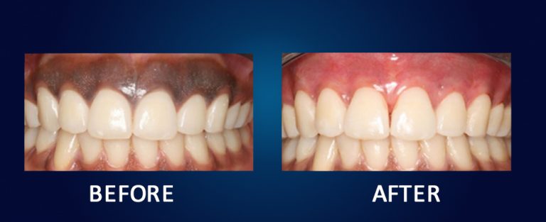 Laser Gum Depigmentation Cost & Treatment in Hyderabad India | Focus ...