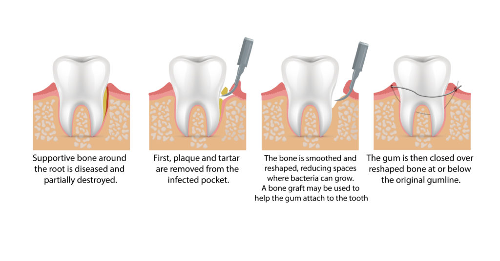 Focus Dental | Flap Surgery for Gums in Hyderabad
