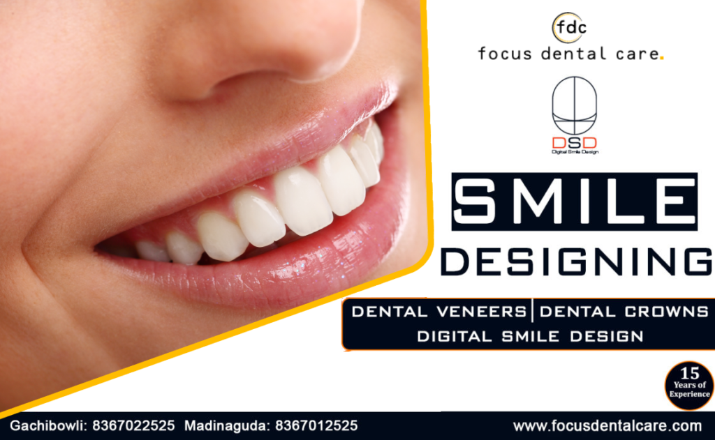 Smile Designing in Hyderabad India - Focus Dental Care